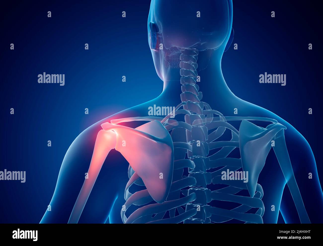 Shoulder injury, illustration Stock Photo - Alamy