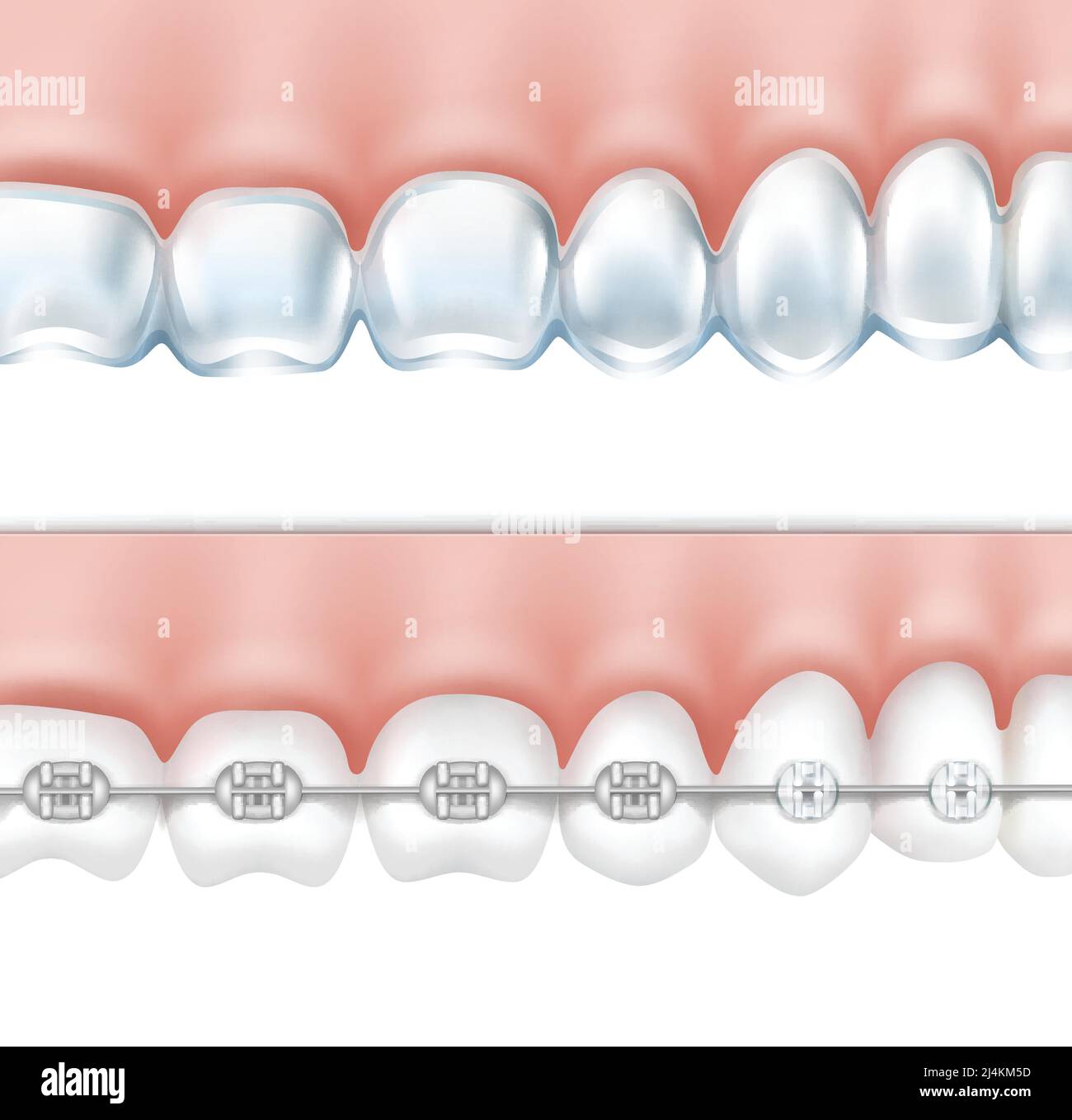 Teeth Before And After Braces Side View