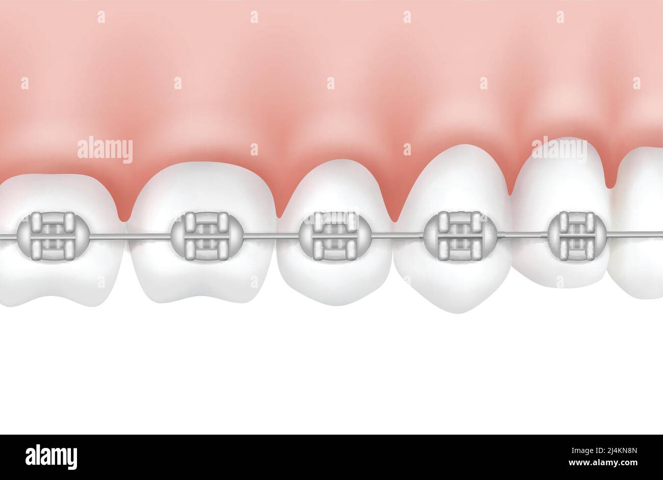 Vector human teeth with metal braces side view isolated on white ...