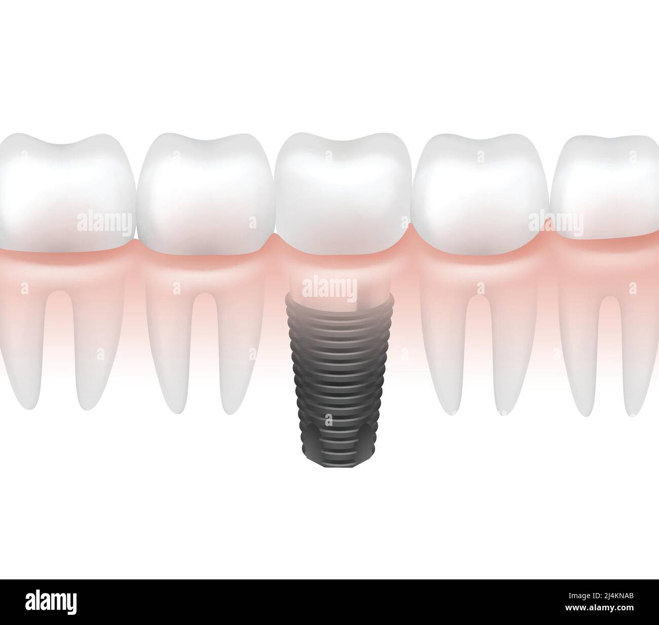 Vector metal dental implant between other teeth in gum side view ...