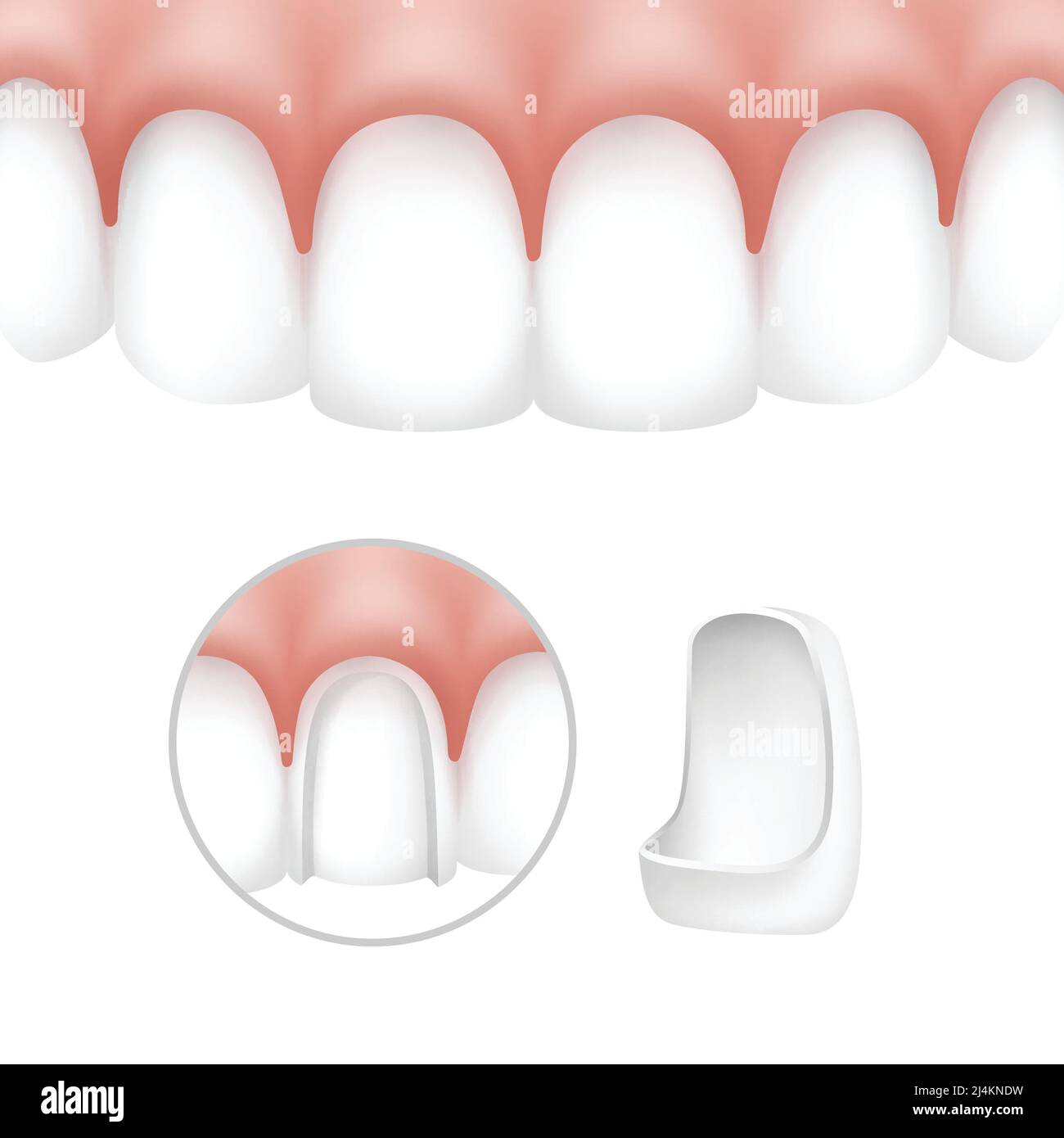 Porcelain veneers vector vectors Stock Vector Images - Alamy