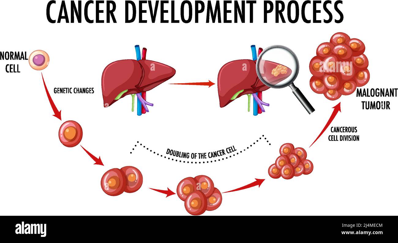 Diagram showing cancer development process illustration Stock Vector ...