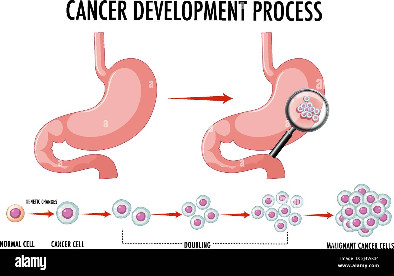 Diagram showing normal and cancer cells in human illustration Stock ...