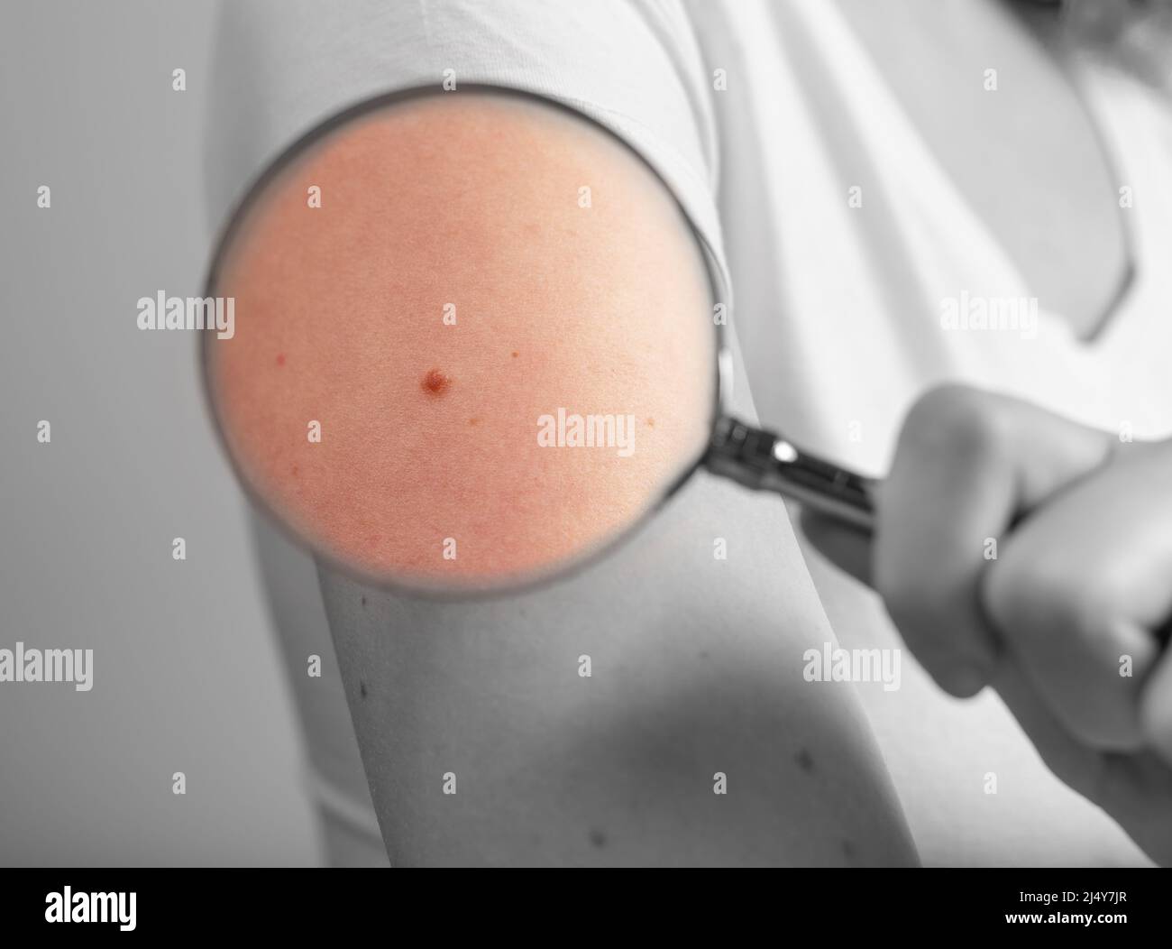 Woman examines mole with magnifying glass. Cancer awareness, health ...