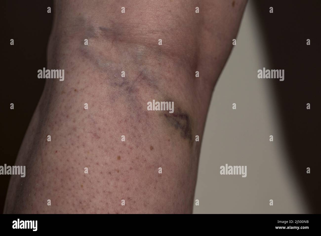 Vein bruise hi-res stock photography and images - Alamy