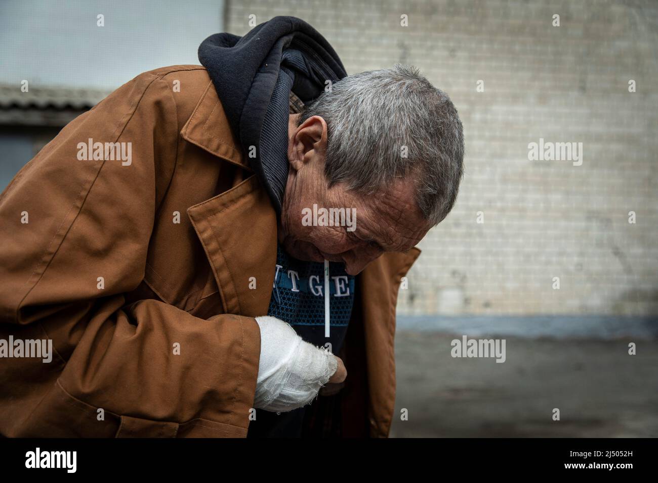 A view of a man who lost his left arm and thumb of his right hand as a ...