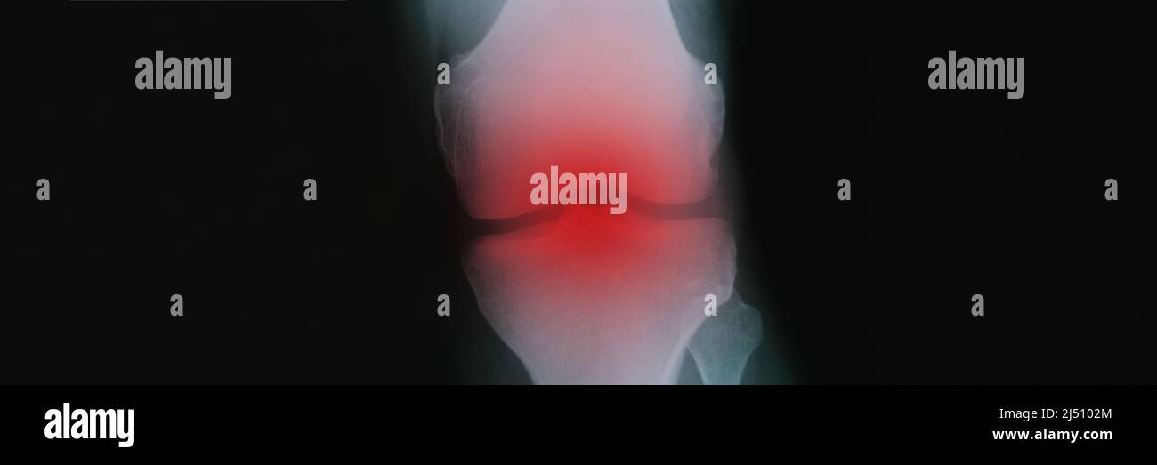 X ray with red inflammation of knee joint closeup Stock Photo - Alamy