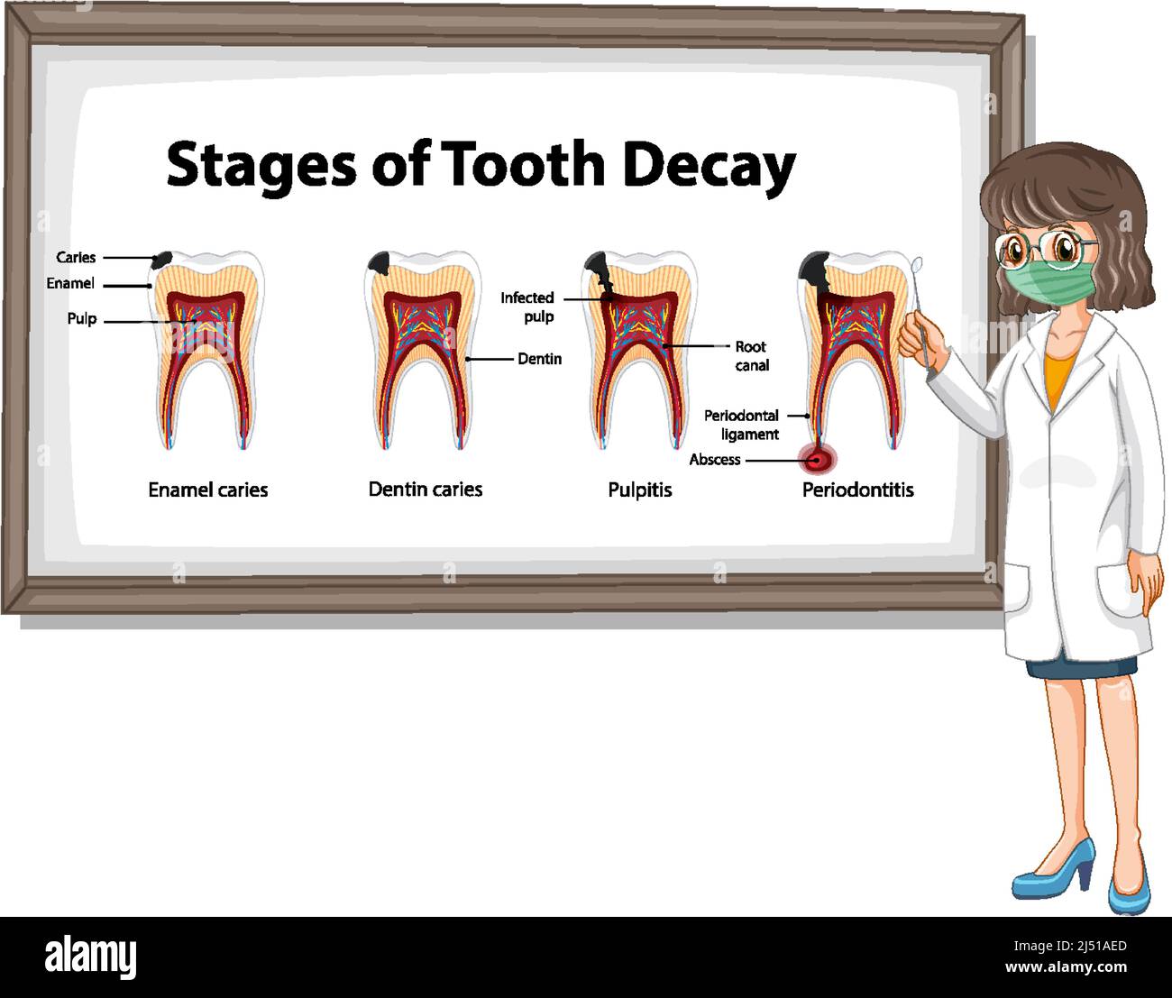 Infographic of human in the stages of tooth decay illustration Stock ...