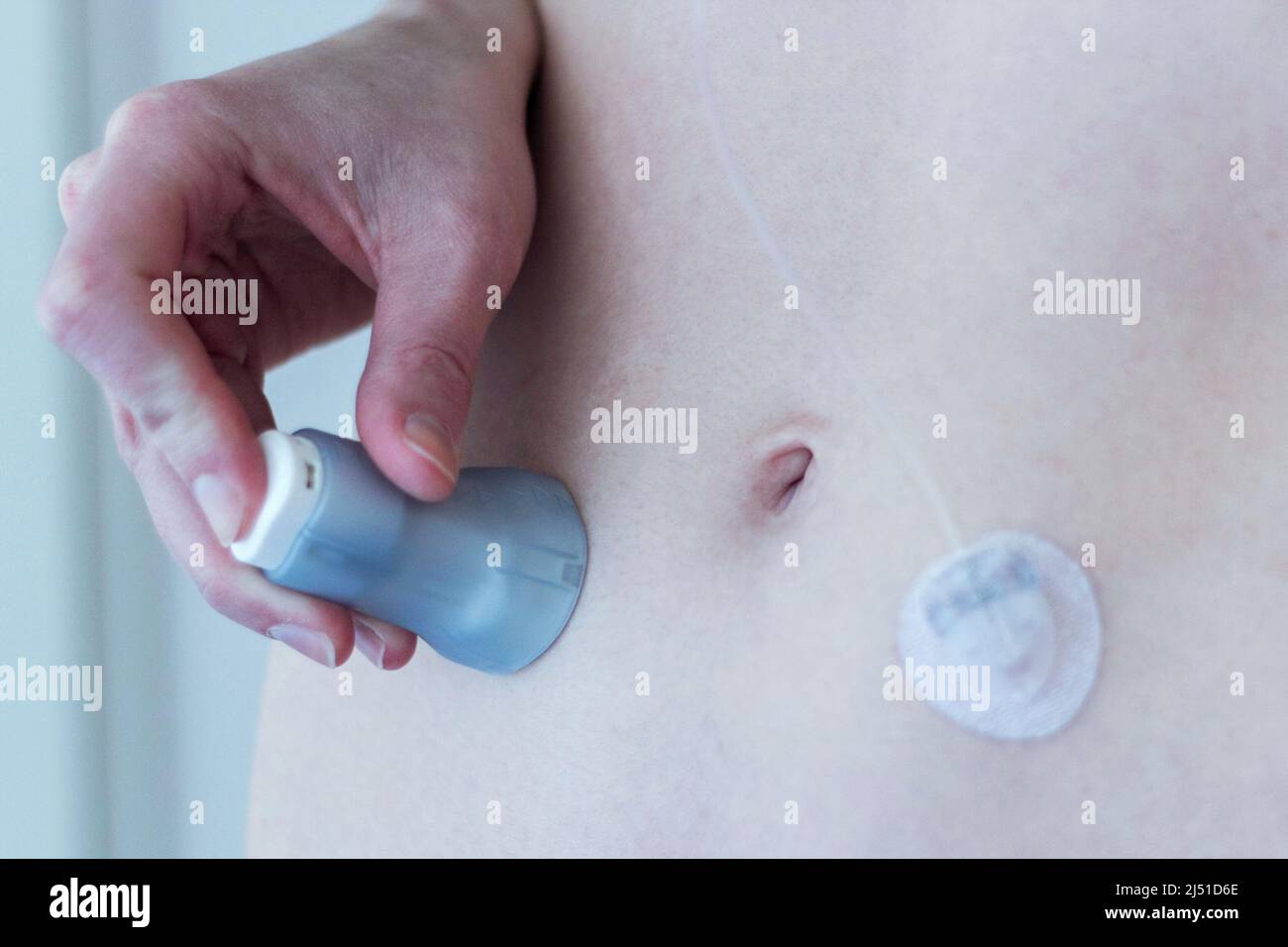Woman placing an infusion set on her belly Stock Photo - Alamy