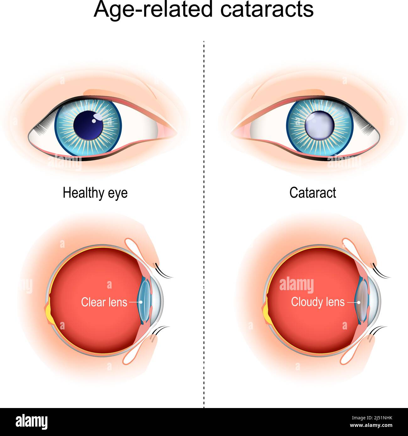 cataracts. Age-related vision problems. Cross-sectional view, showing ...