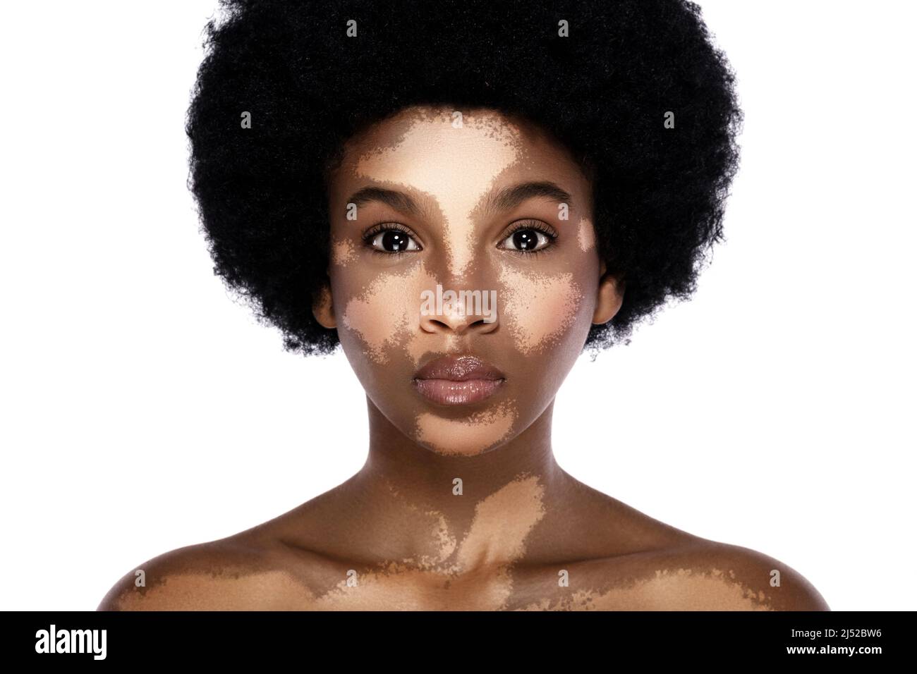 Portrait of young and beautiful black woman with vitiligo skin disorder ...