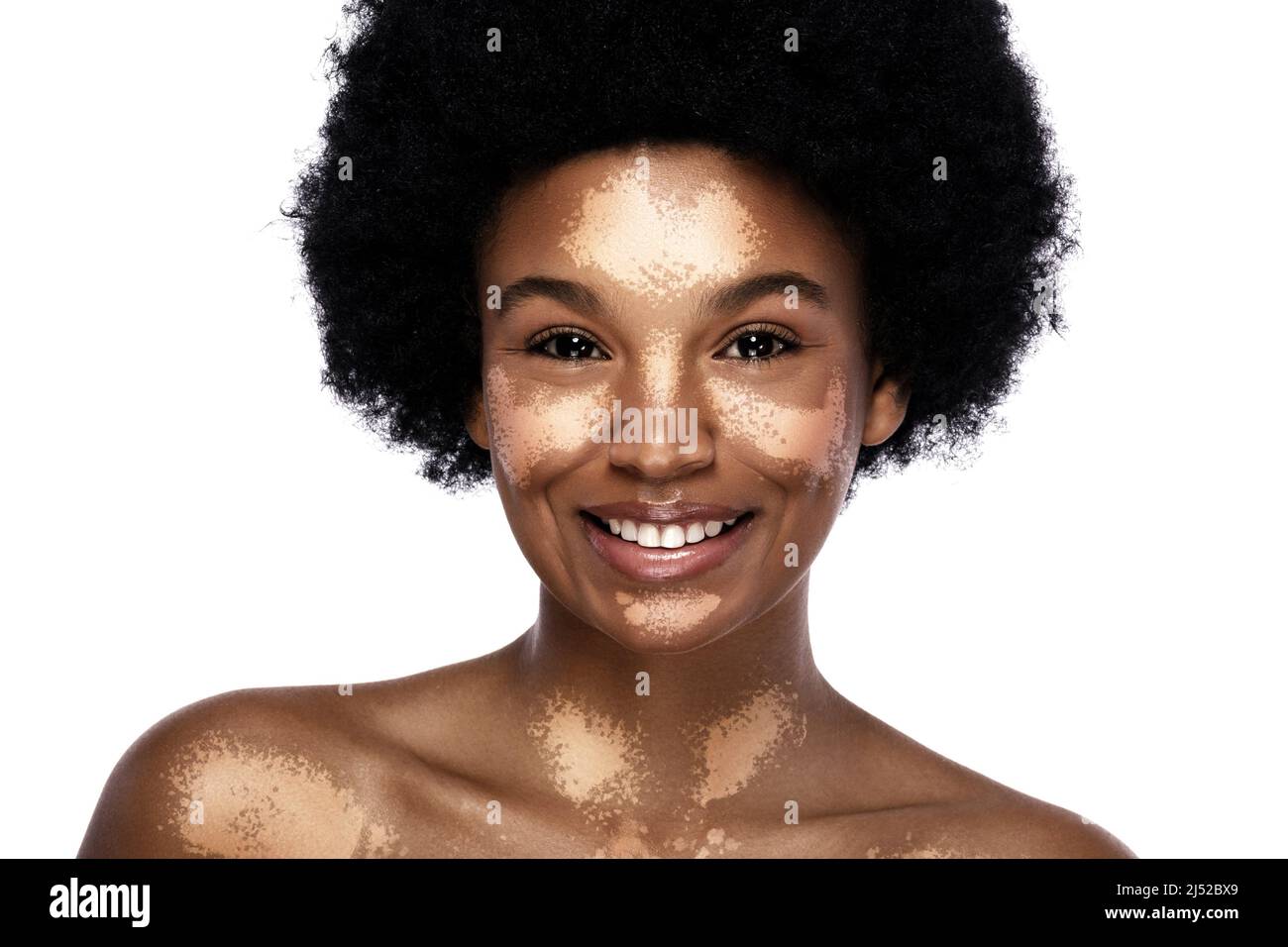 Portrait of young and beautiful black woman with vitiligo skin disorder ...