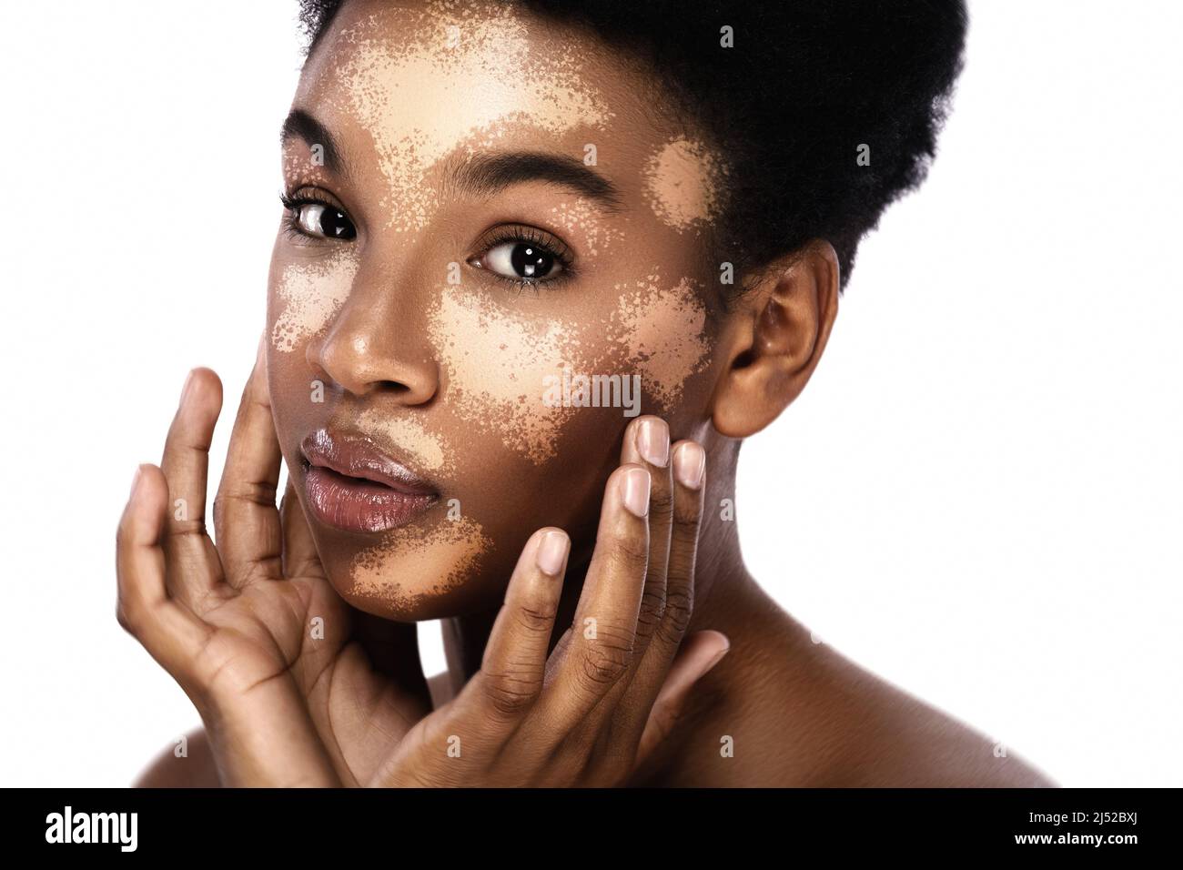 Portrait of young and beautiful black woman with vitiligo skin disorder ...