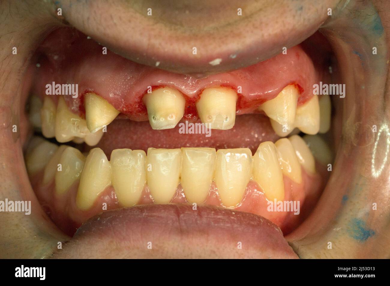 Dental crown preparation Stock Photo - Alamy