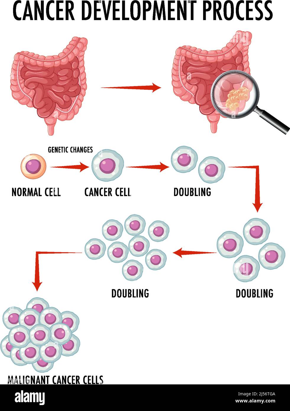 Diagram showing normal and cancer cells in human illustration Stock ...