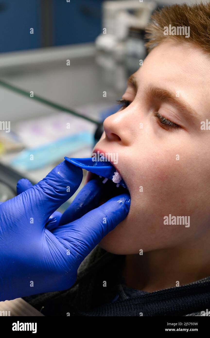 Jaw impression with a silicone diagnostic model, crooked teeth in a ...