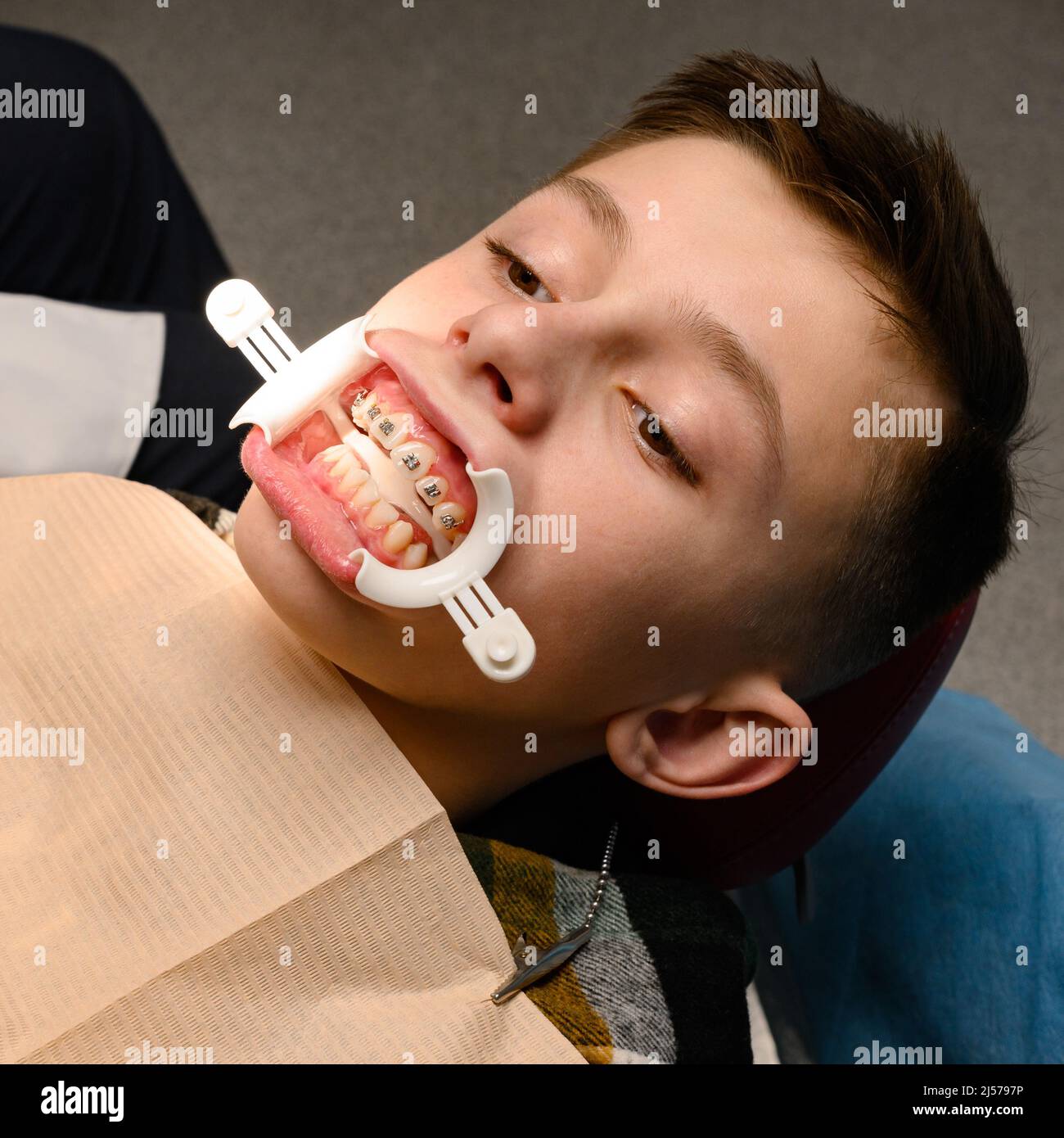 Visit to the orthodontist, installation of braces on the upper teeth ...