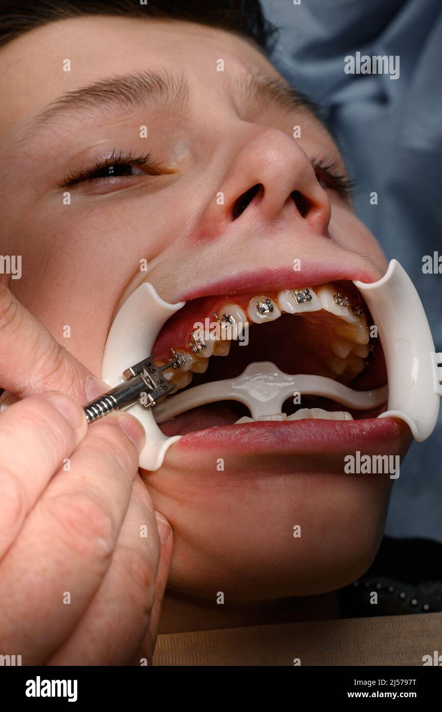 The teenager's boy is glued braces on his upper teeth to straighten ...