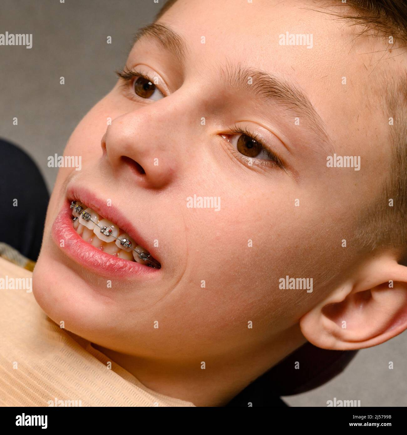 regular visit to the orthodontist of the patient with braces, braces on ...