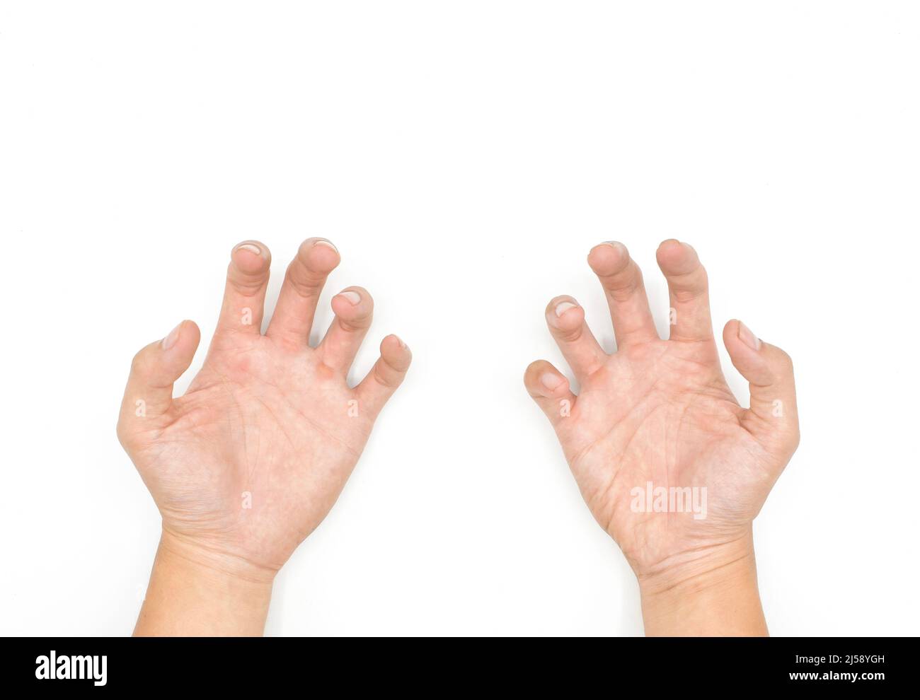 Volkmann contracture in upper limb of Asian young man. It is a ...