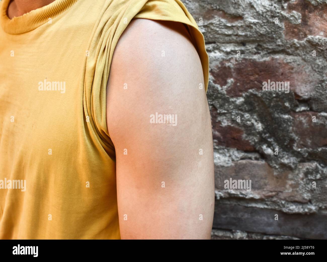 BCG or TB vaccine scar mark at the arm of Southeast Asian man Stock ...