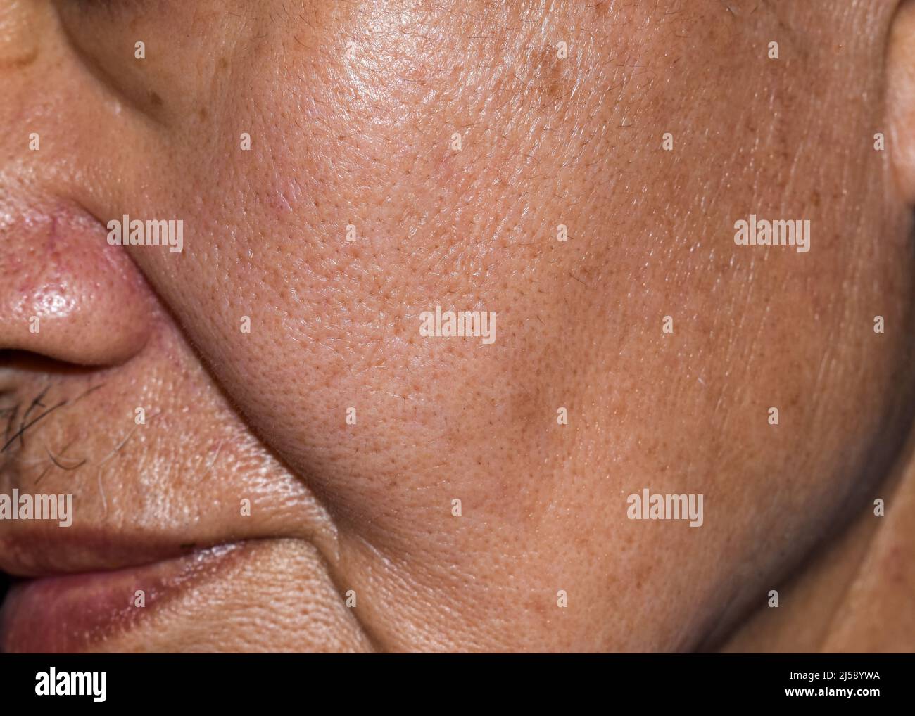 Enlarged pores in oily face of Southeast Asian, Chinese elder man with ...