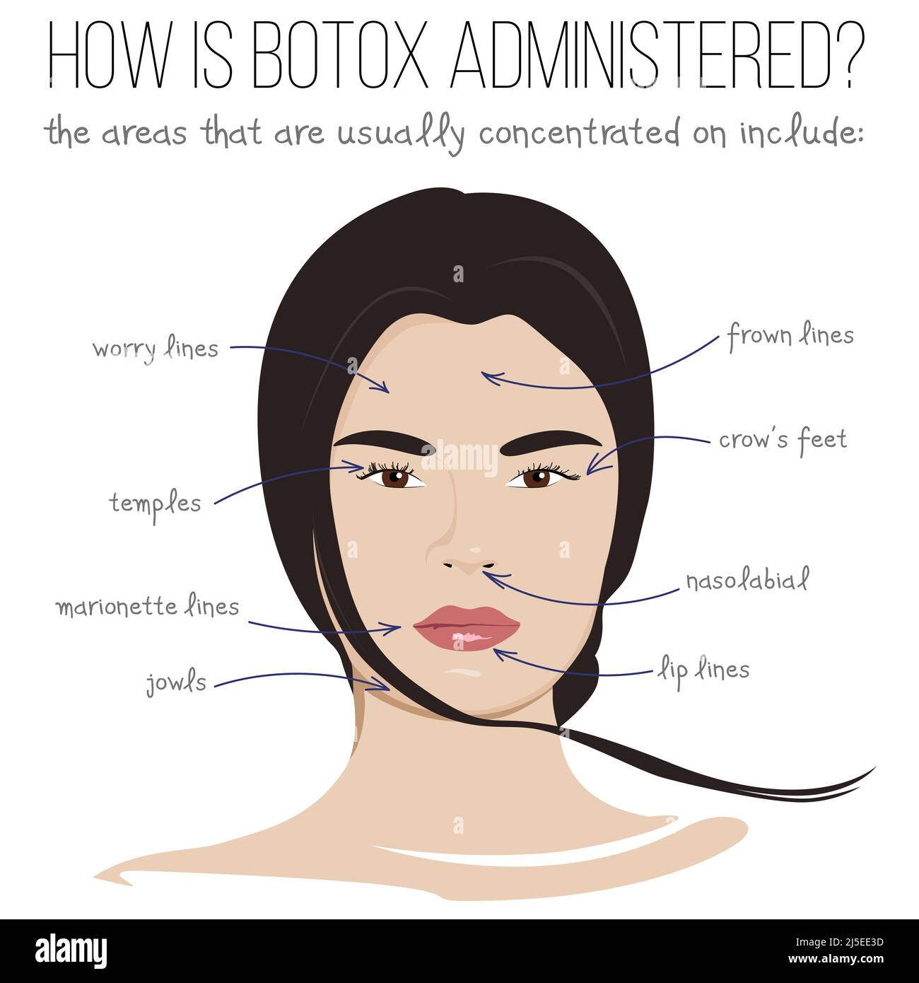 Botulinum toxin injection Stock Vector Images - Alamy