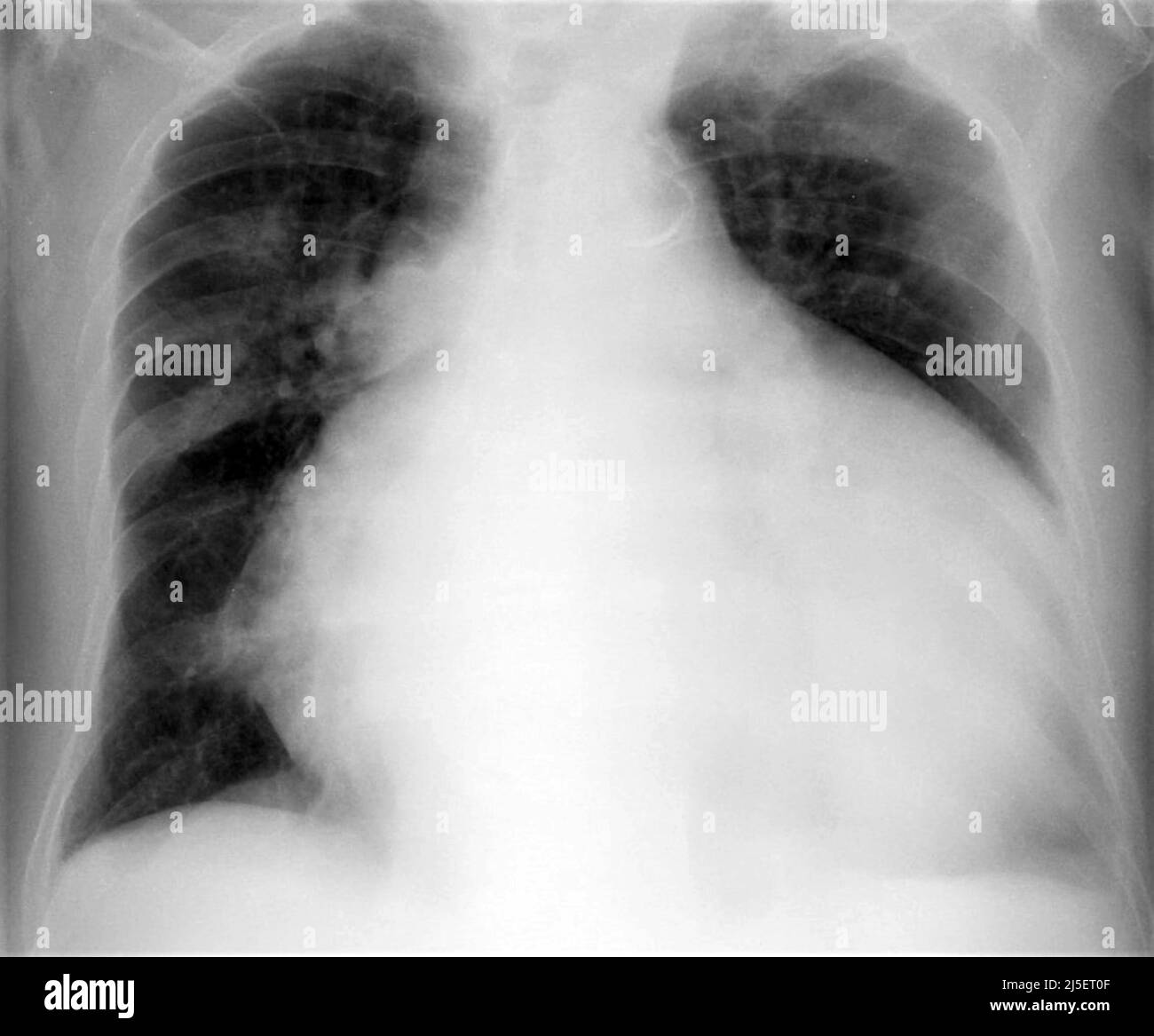Enlarged heart, X-ray Stock Photo - Alamy
