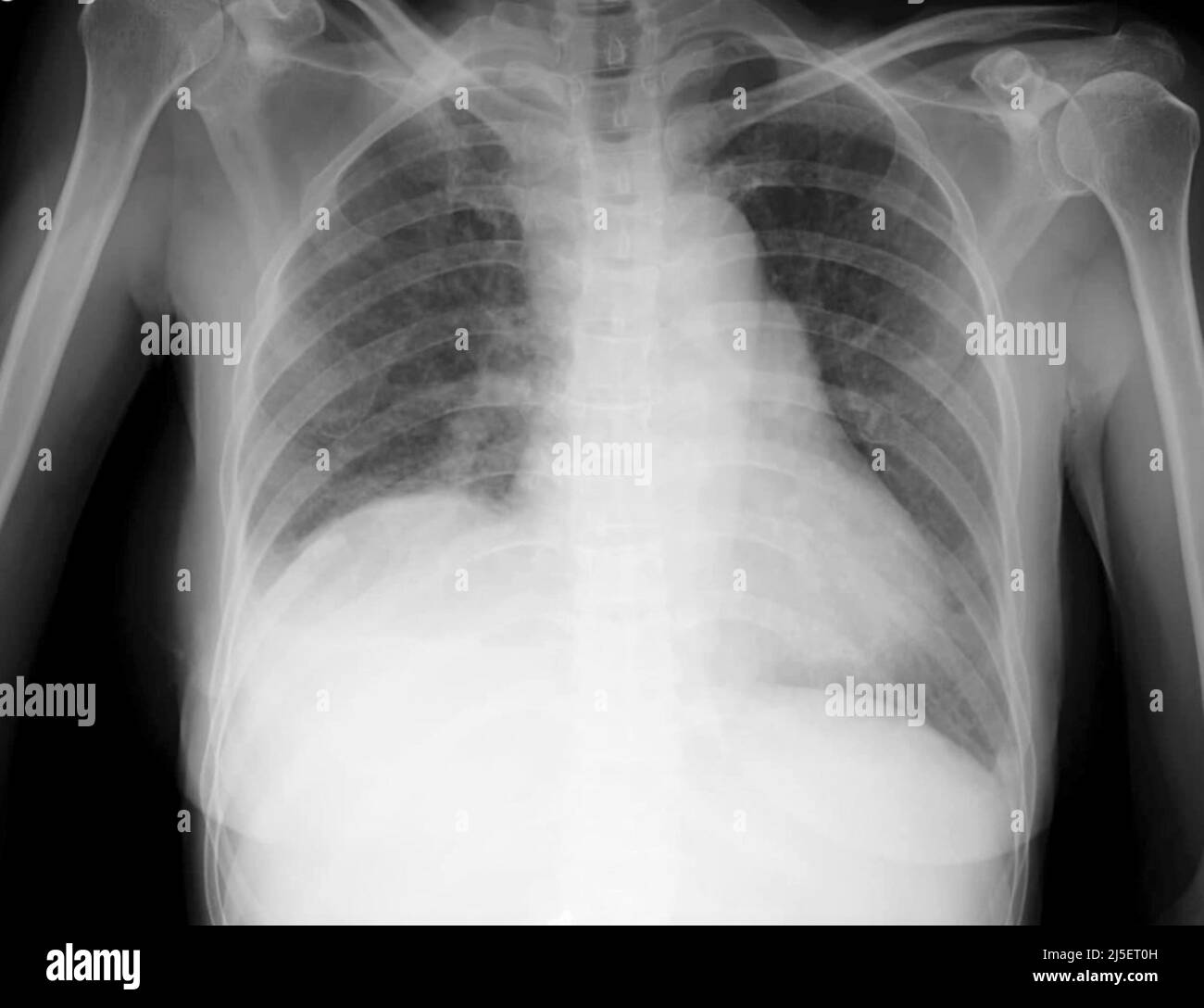 Miliary nodules, X-ray Stock Photo - Alamy