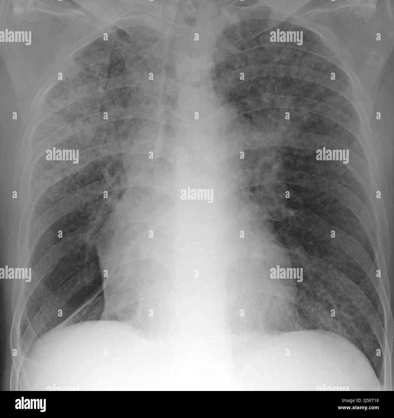 Miliary nodules, X-ray Stock Photo - Alamy