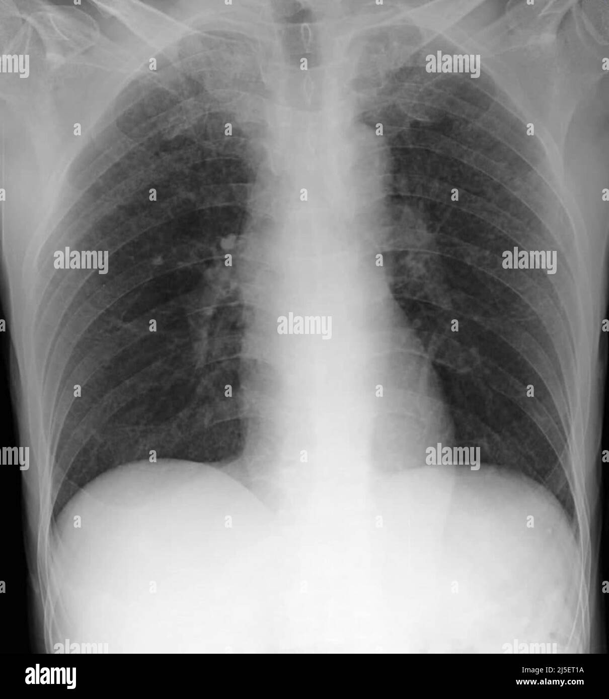 X-ray of a patient with miliary nodules. Miliary refers to innumerable ...