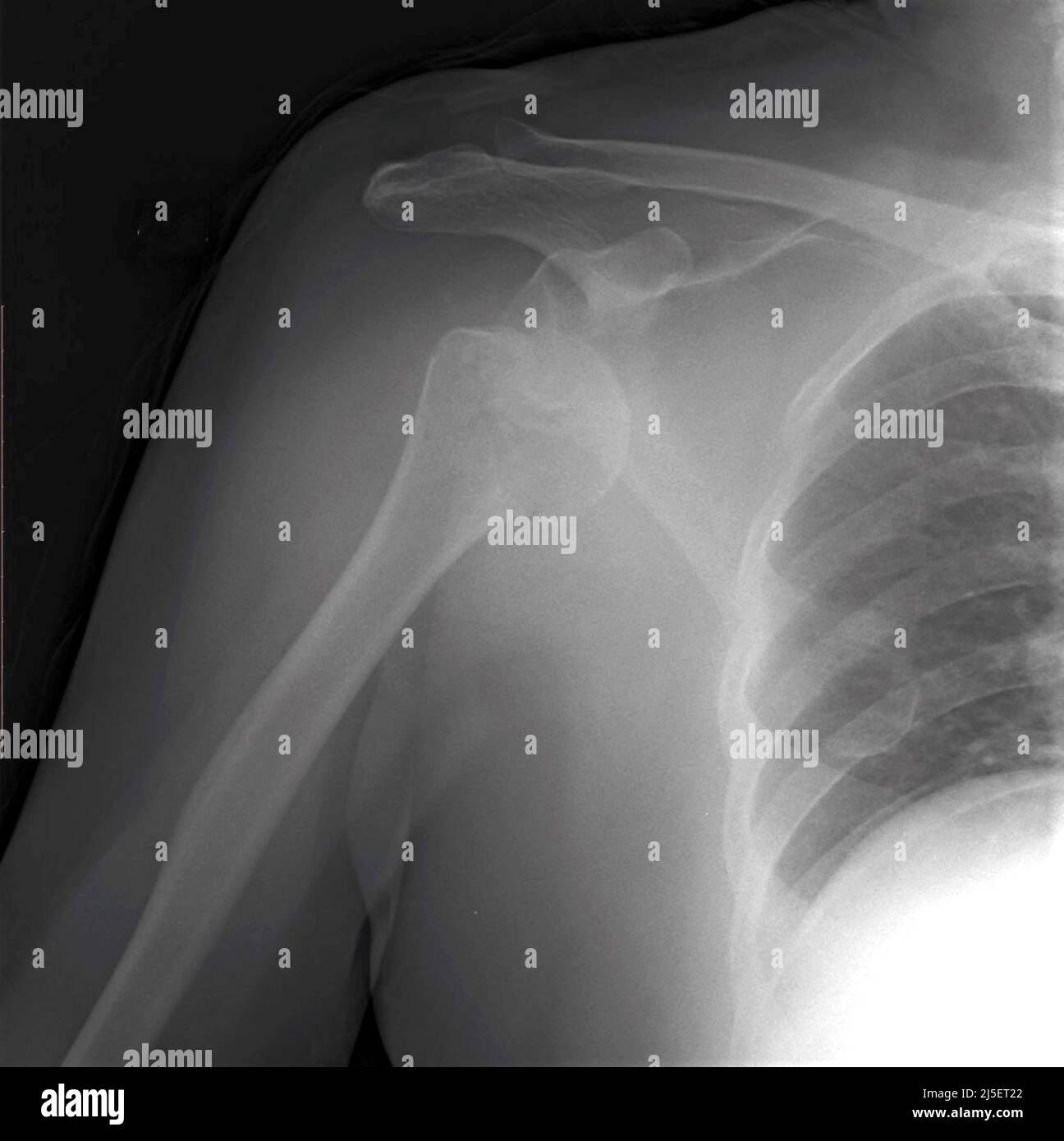 Anterior shoulder dislocation hi-res stock photography and images - Alamy