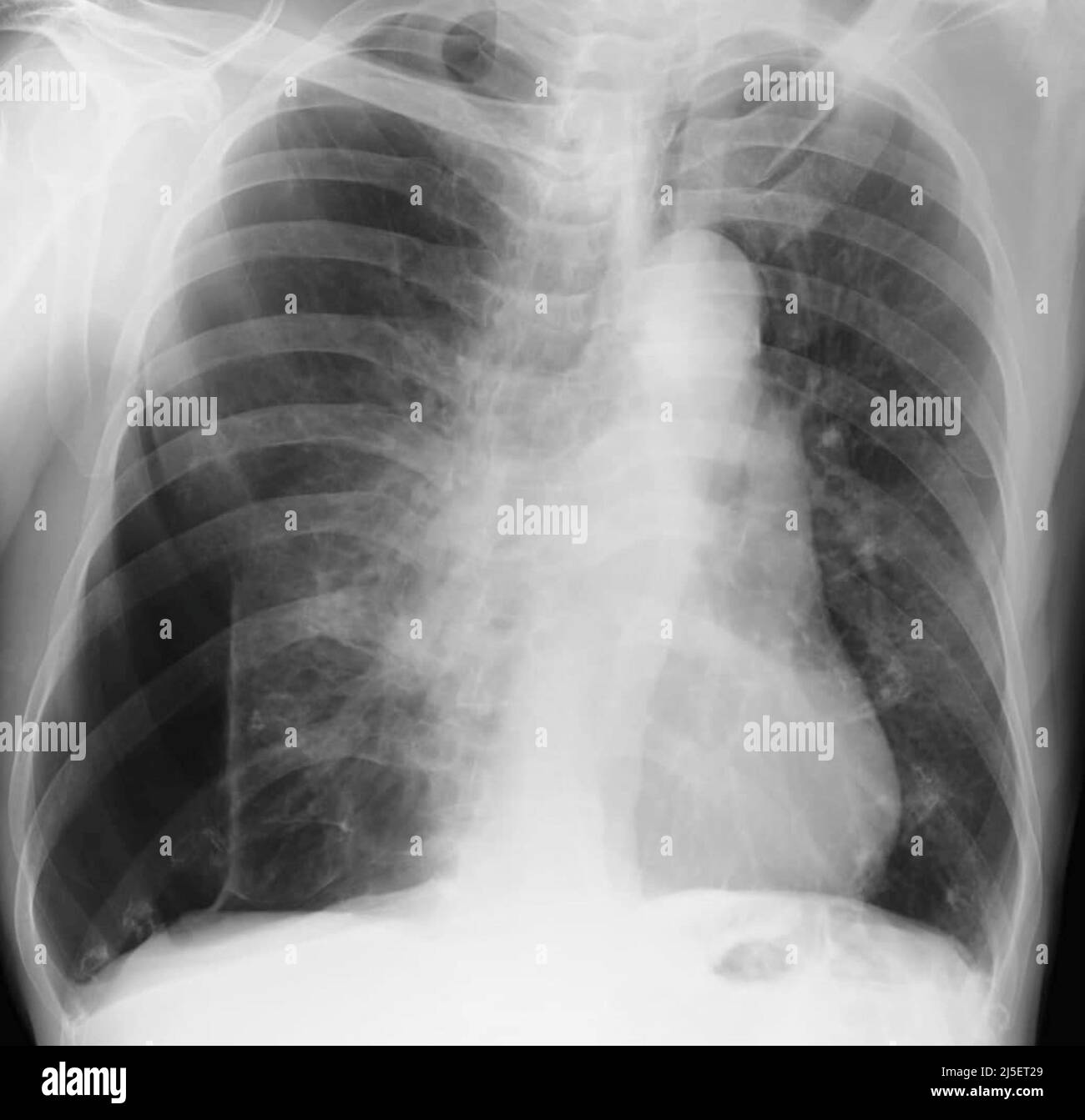 Thorax x ray hi-res stock photography and images - Alamy