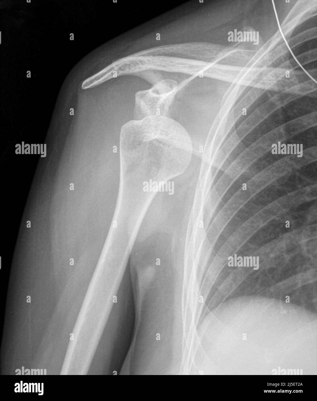 Shoulder dislocation hi-res stock photography and images - Alamy