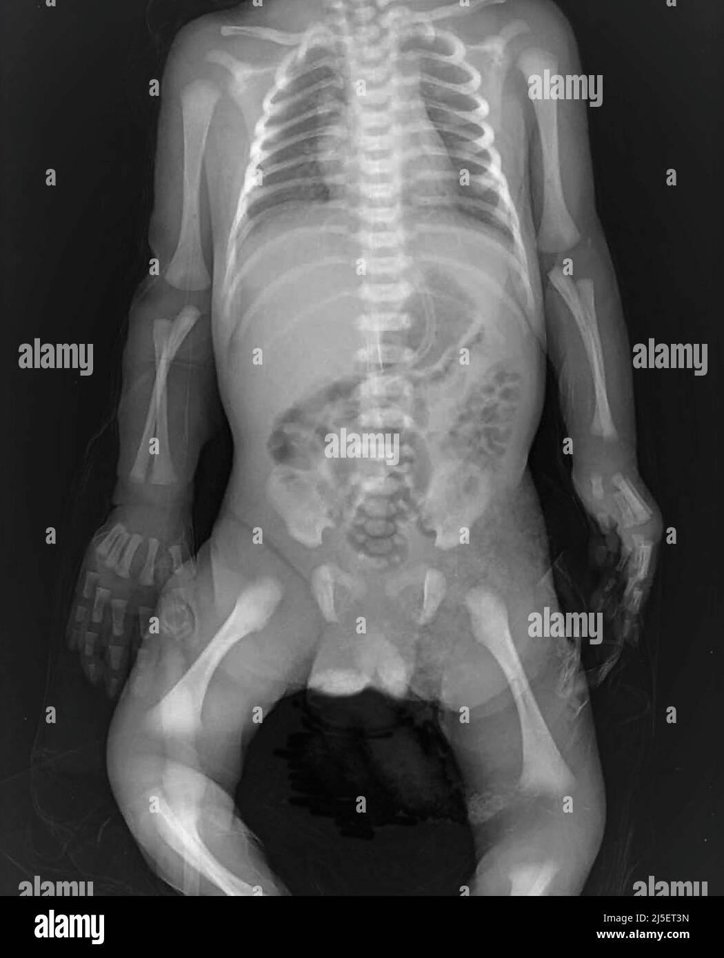 X-ray of a 1 day old baby showing a normal chest, normal abdomen and ...