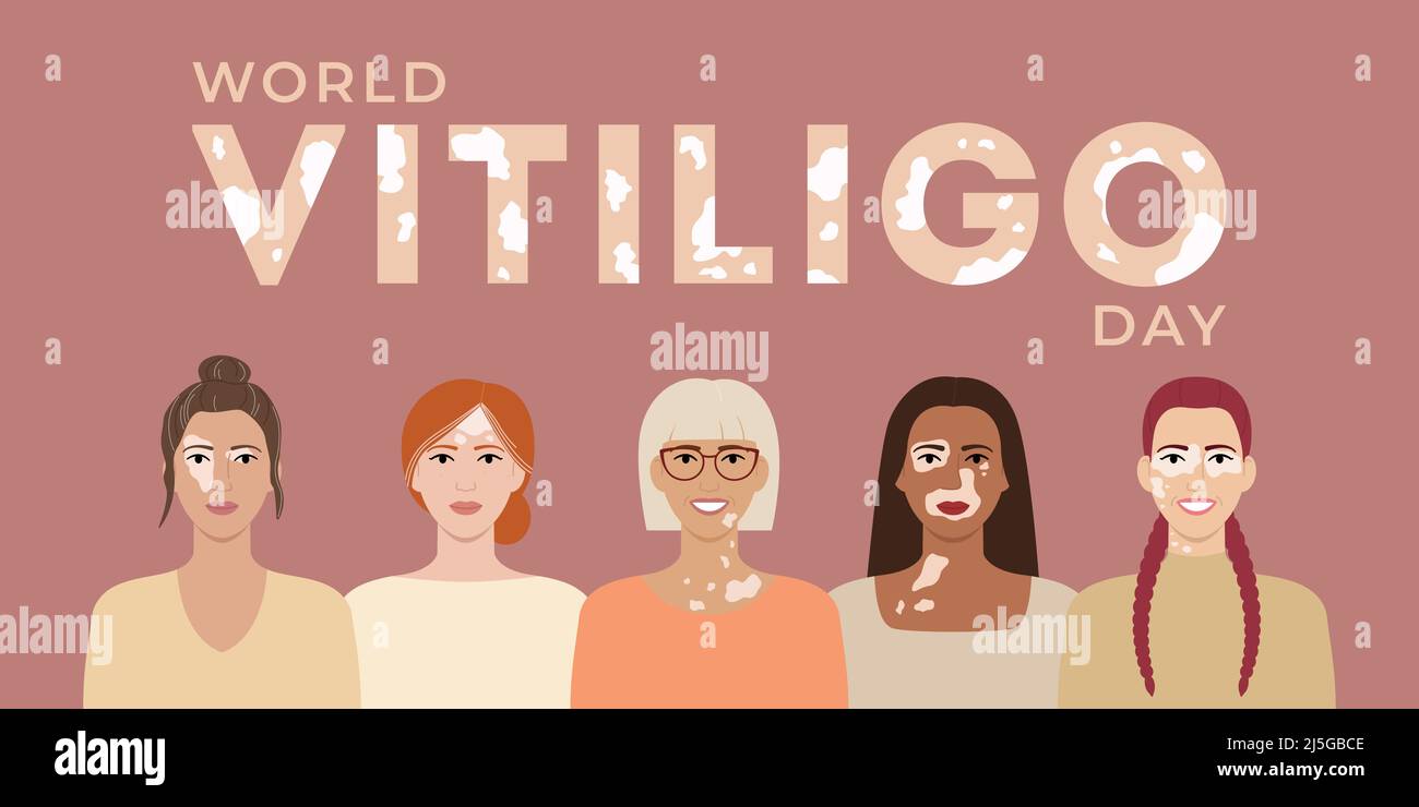World vitiligo day June 25 banner. Female faces with different ethnics ...