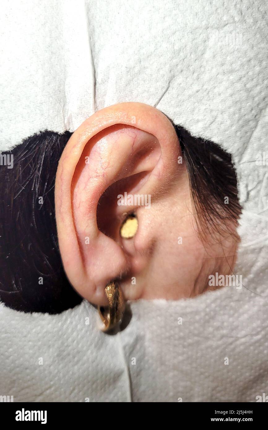 Human ear with yellow gray inside, clogged ear canal, close-up Stock ...