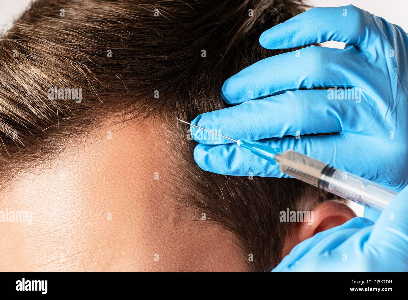Man receiving scalp injection for hair grow Stock Photo - Alamy