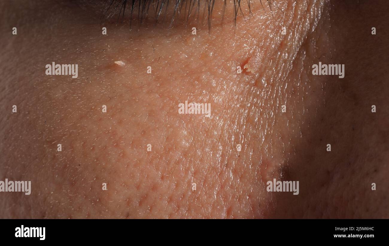 Wart skin removal. Macro shot of warts near eye on face. Papilloma on ...