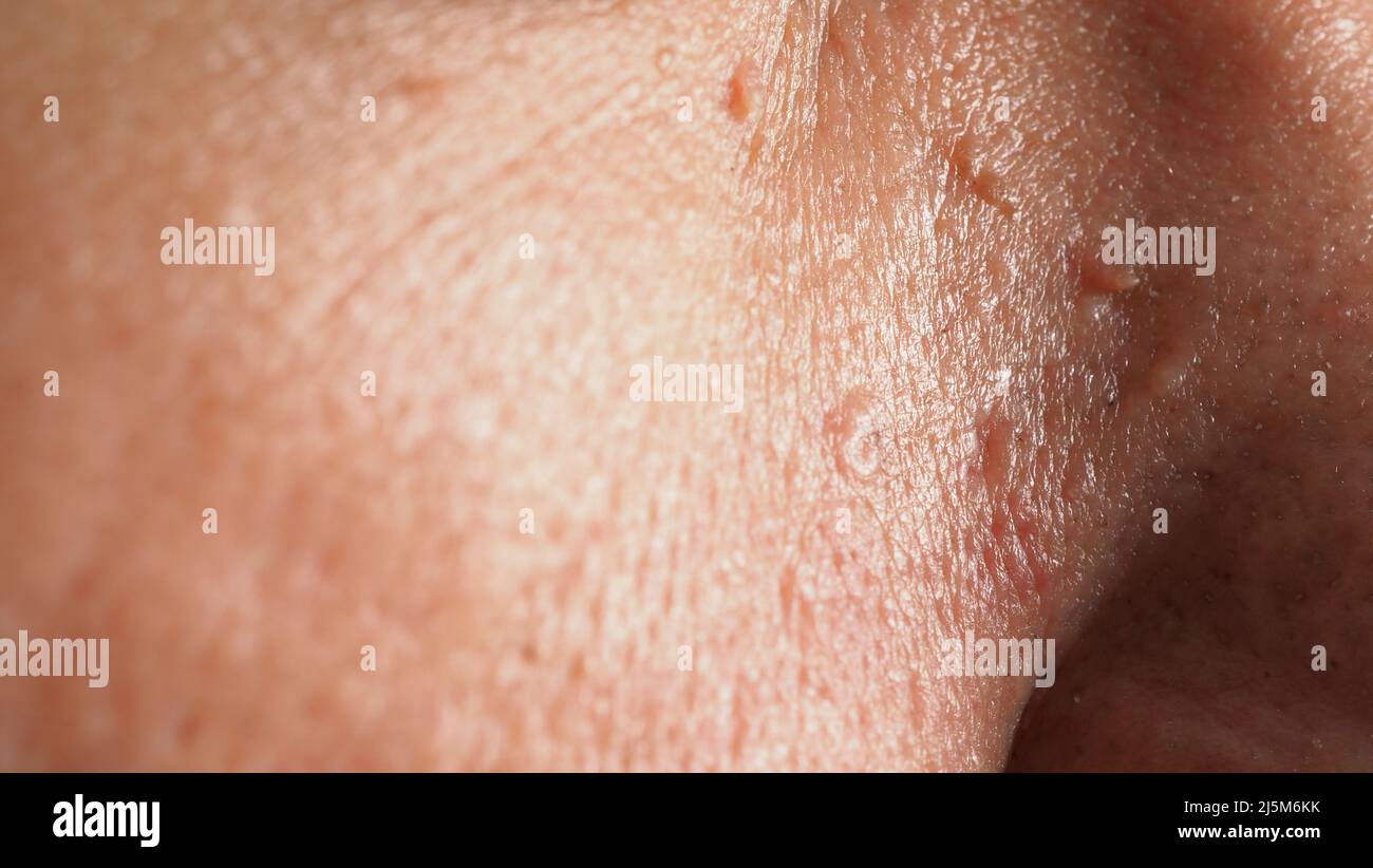 Wart skin removal. Macro shot of warts near eye on face. Papilloma on ...
