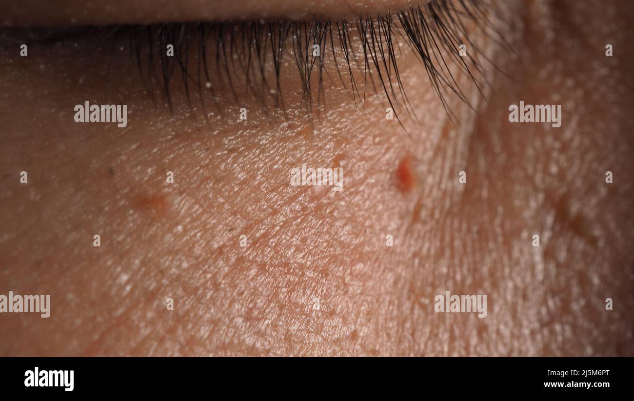 Wart skin removal. Macro shot of warts near eye on face. Papilloma on ...