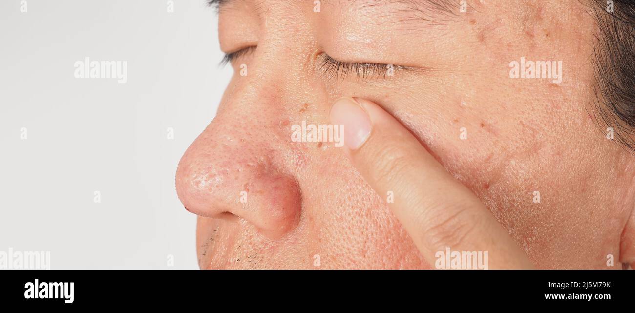 Facial wart hi-res stock photography and images - Alamy