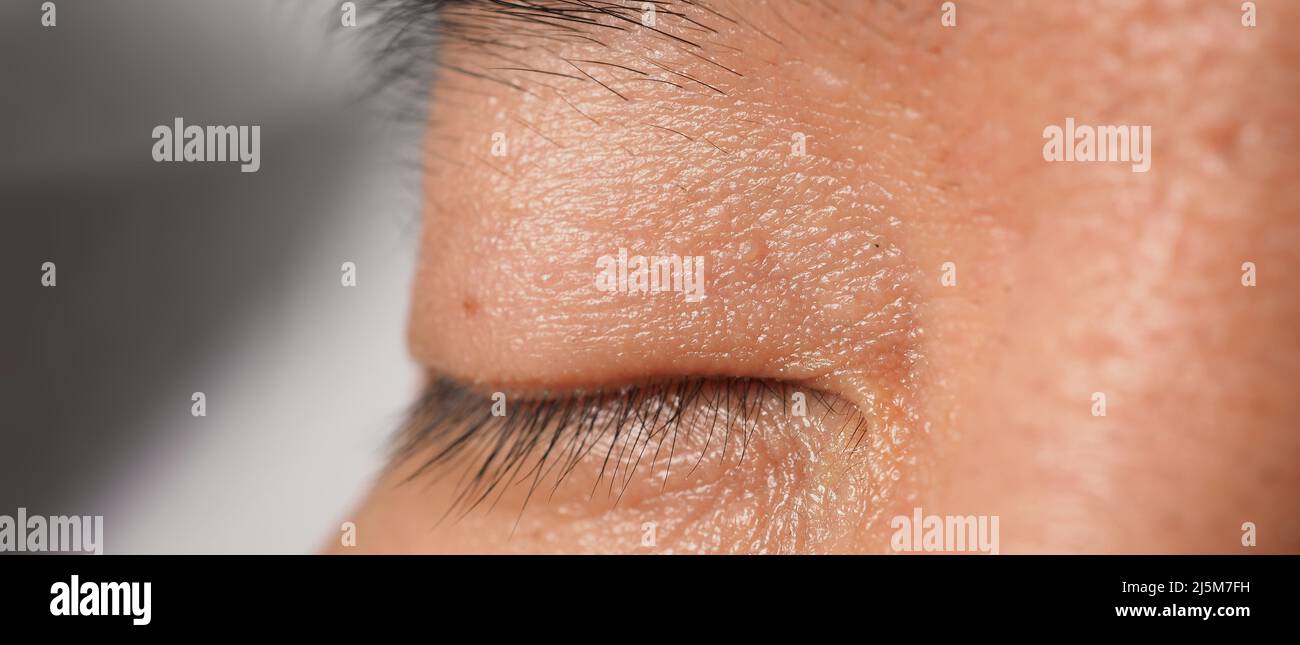 Wart skin removal. Macro shot of warts near eye on face. Papilloma on ...