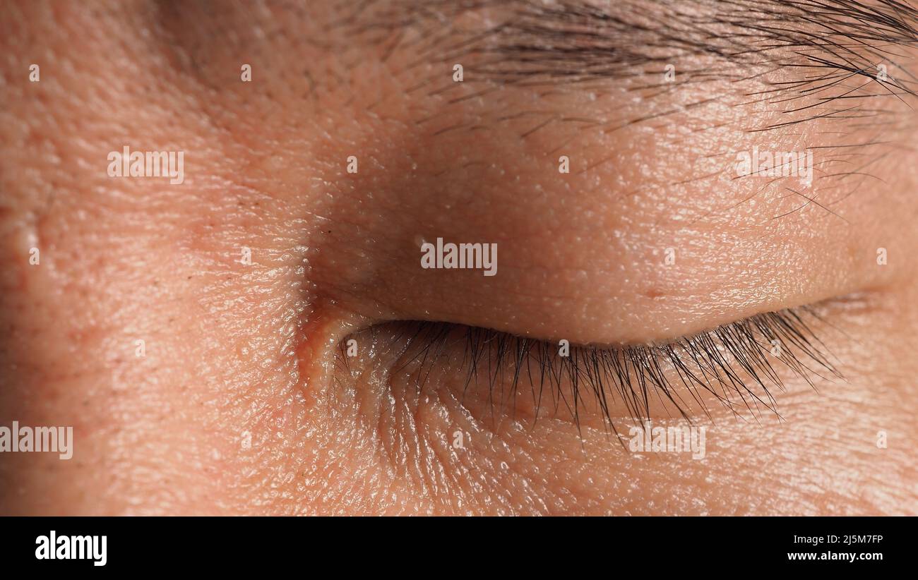 Wart skin removal. Macro shot of warts near eye on face. Papilloma on ...