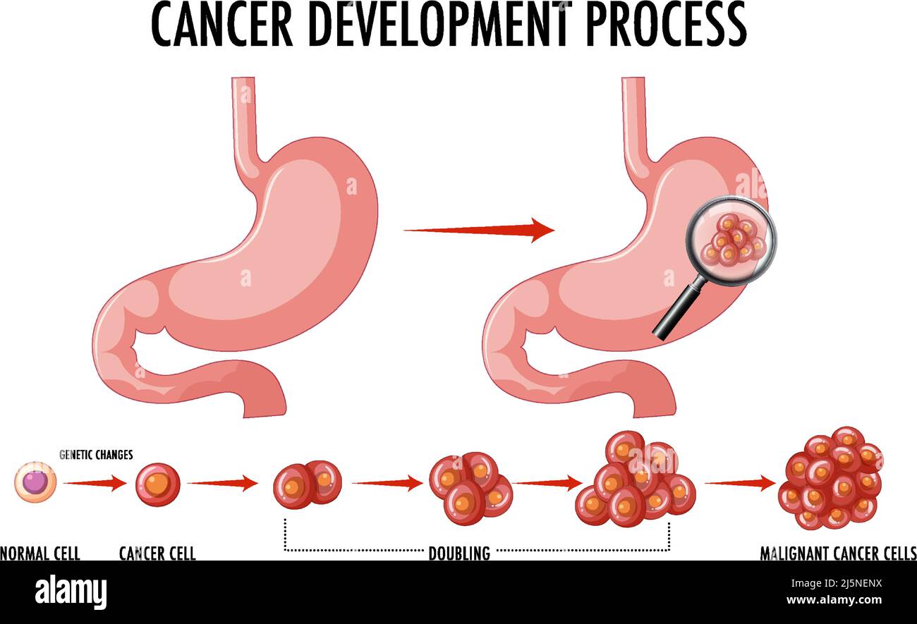 Diagram showing cancer development process illustration Stock Vector ...