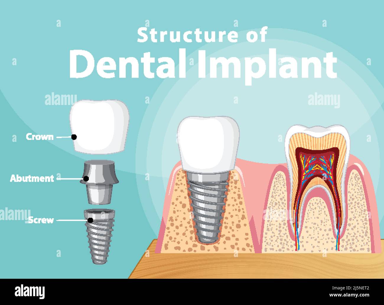 Infographic of human in structure of the dental implant illustration ...