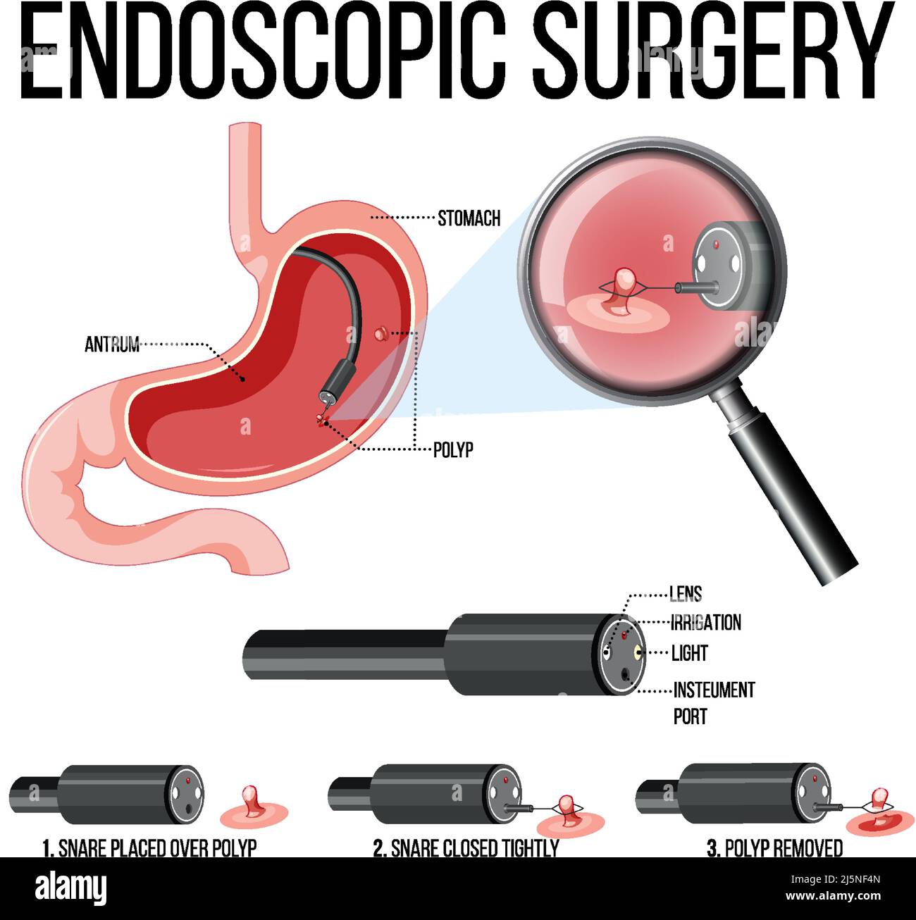 Diagram showing endoscopic surgery illustration Stock Vector Image ...