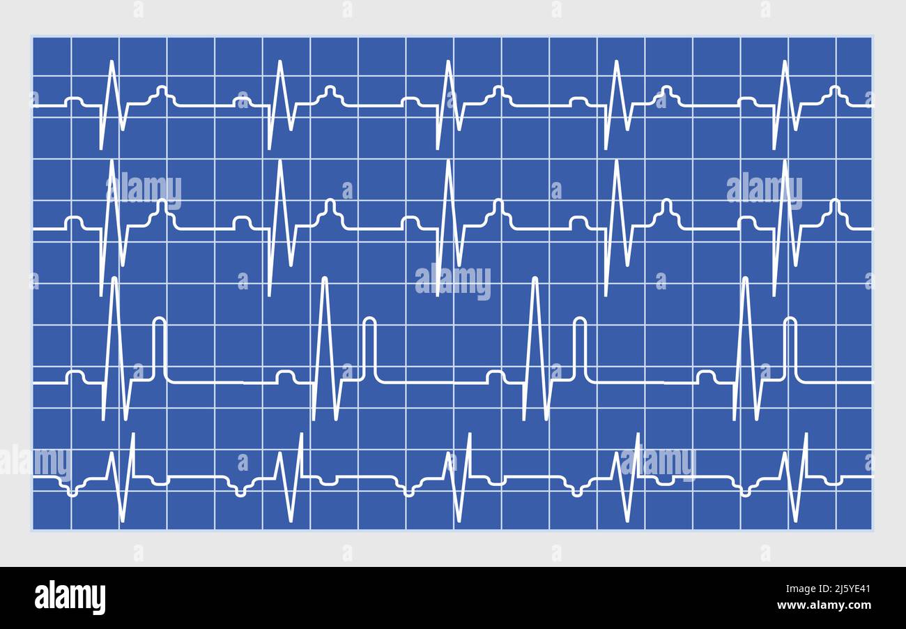 Electrocardiogram Scan Result Vector Concept Ekg Monitor For Emergency