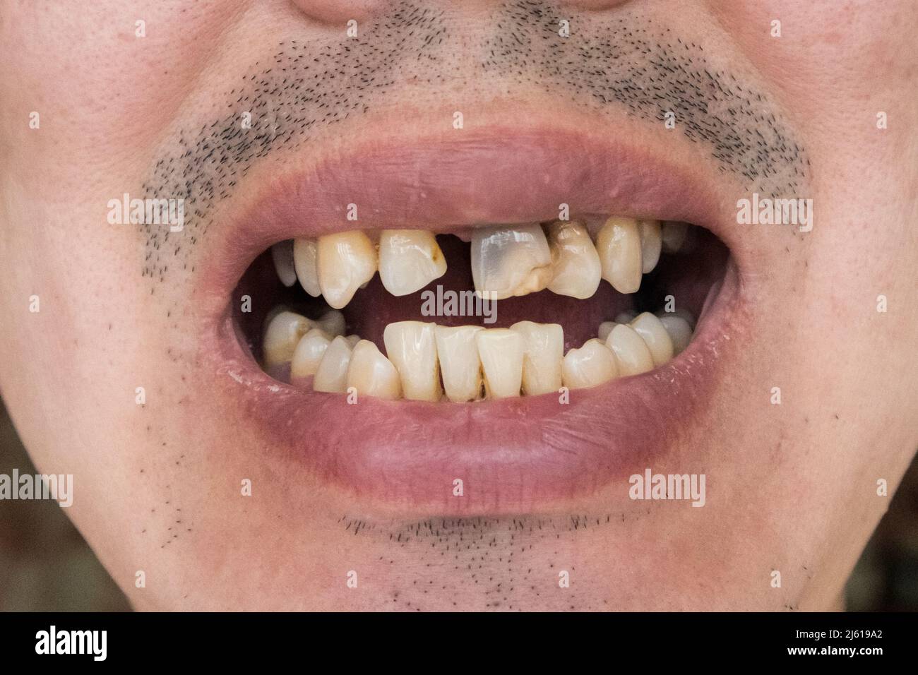 Jagged smile hi-res stock photography and images - Alamy