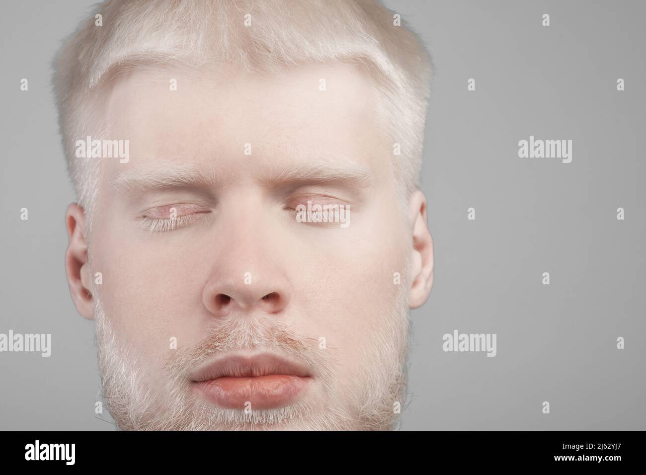 Albinism, abnormal deviations concept. Unusual bearded albino man ...